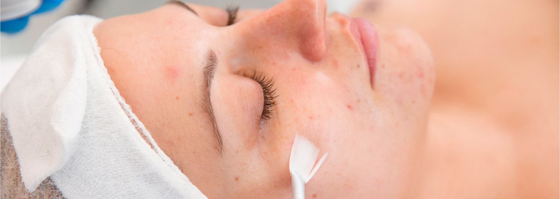 Infórmate Aquí Sobre El Peeling Químico Médico | CEMP